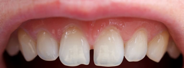 Why are my teeth transparent? - Atlanta Orthodontic Specialists