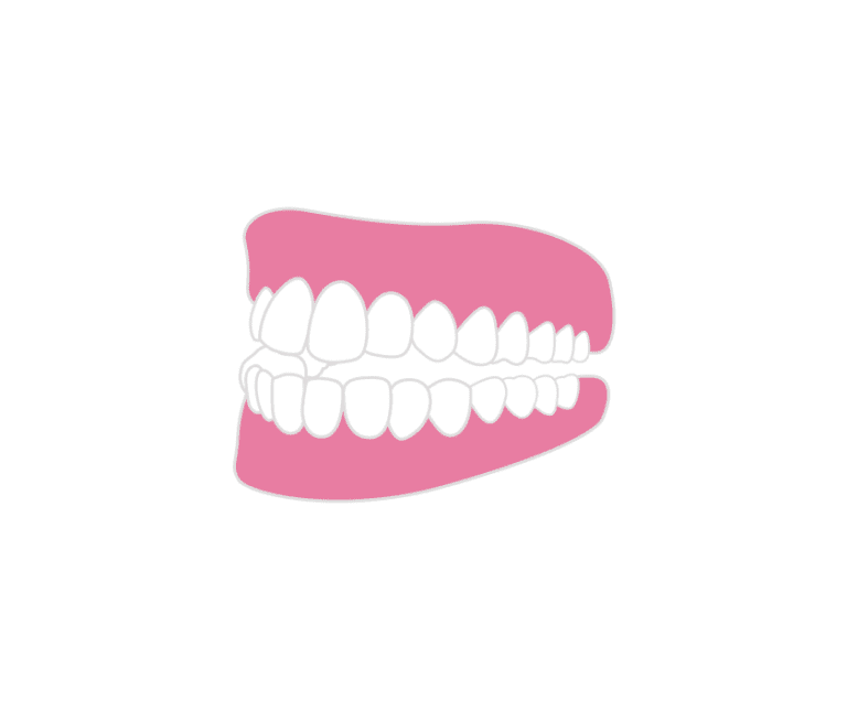 Open Bite Treatment in Atlanta | Atlanta Orthodontic Specialists
